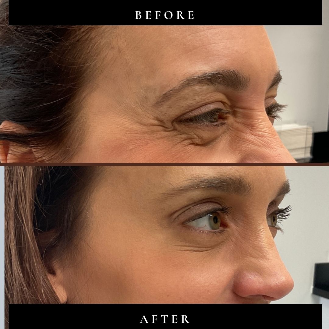Botox 2 - La Bella Medical Aesthetics
